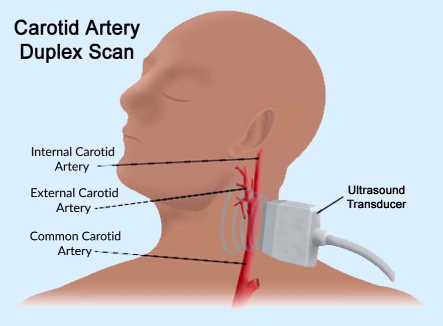 Carotid Artery Disease Sfvvg