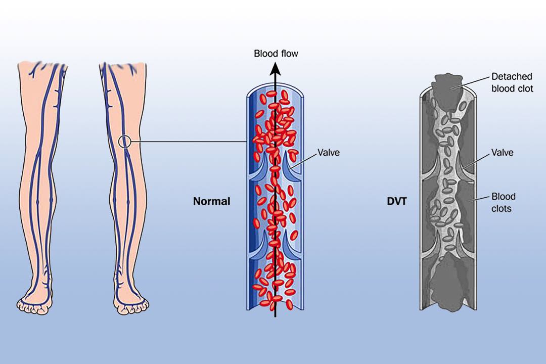Deep Vein Thrombosis/DVT | SFVVG
