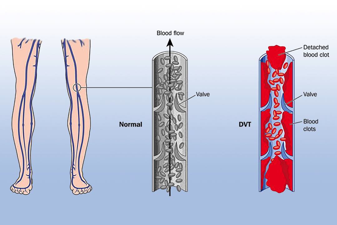 Deep Vein Thrombosis/DVT | SFVVG