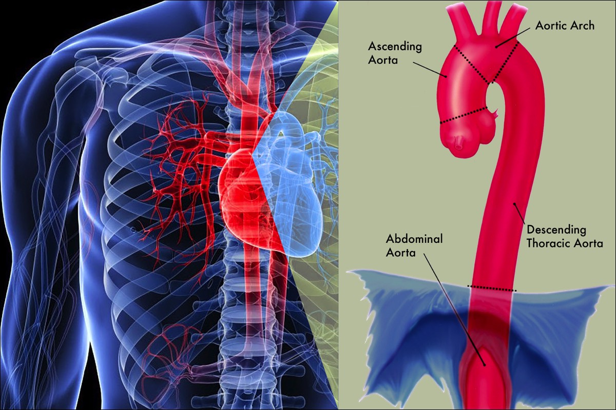Thoracic Aneurysm SFVVG