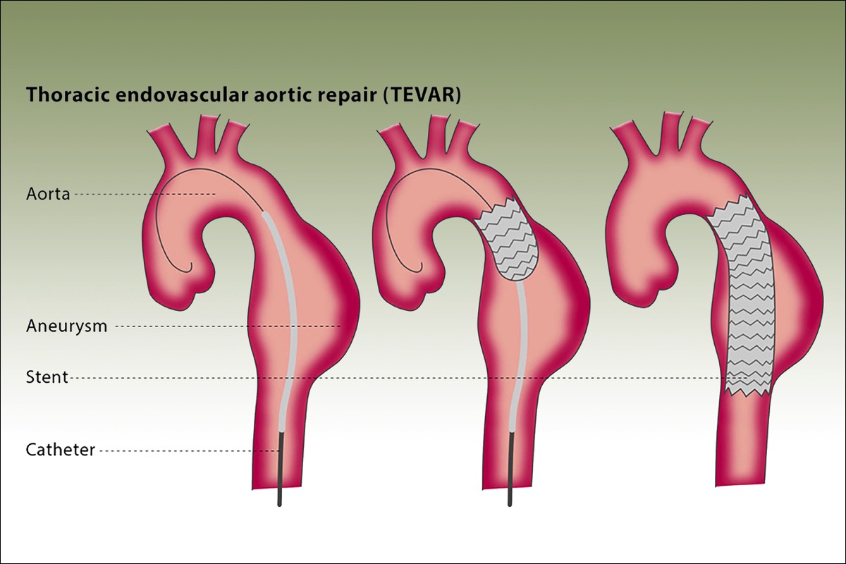 Thoracic Aneurysm SFVVG
